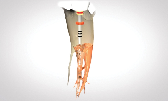 GuttaCore Obturators | Dentsply Sirona